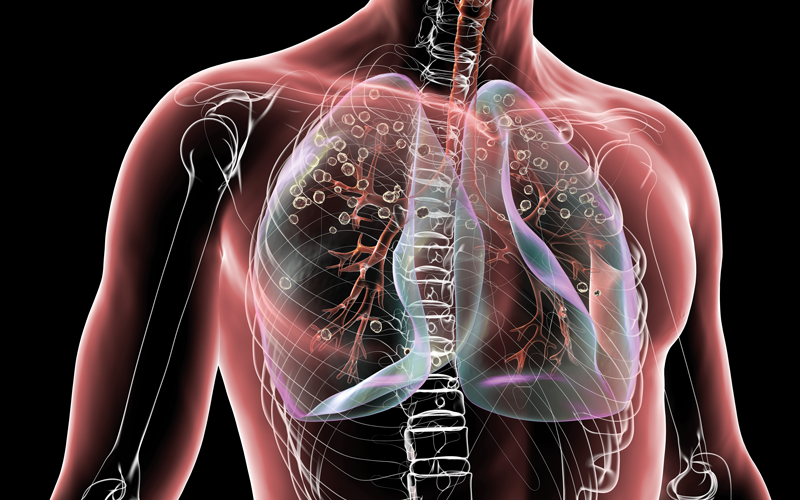 Silicosis and engineered stone: the next asbestosis? | IOSH magazine